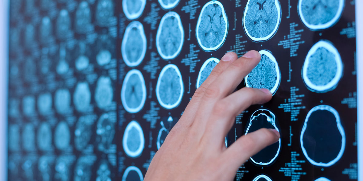 Proton Therapy For Brain Cancer